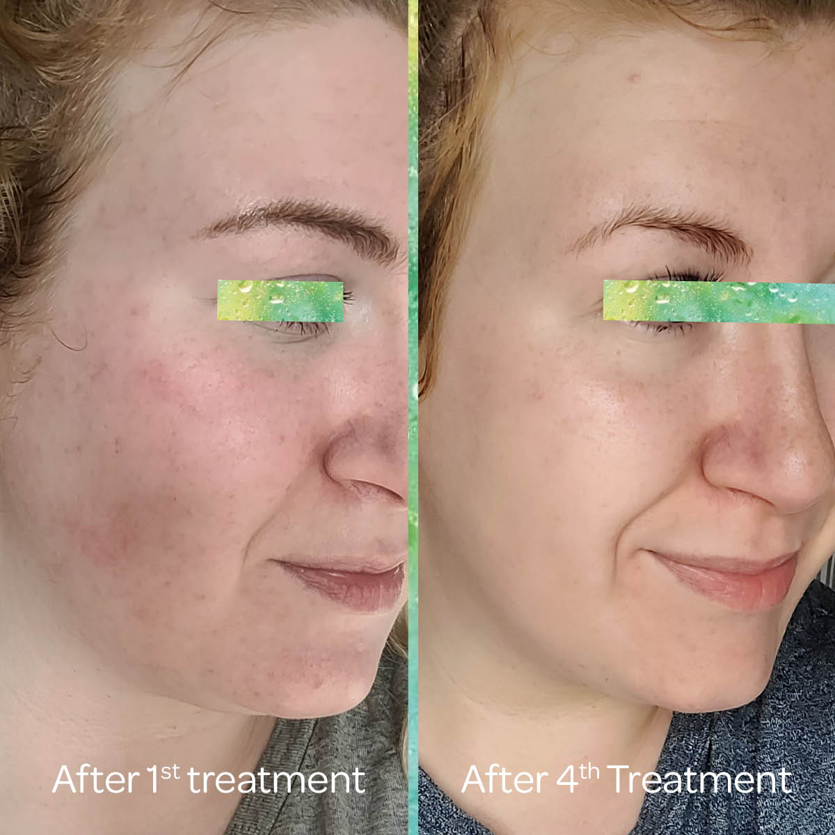 A first time experience of BioRePeel - BF Mulholland Ltd